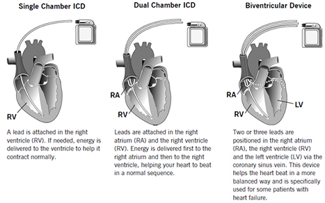 Brady & Tachy Arrhythmias – Heart Rhythm Assoc